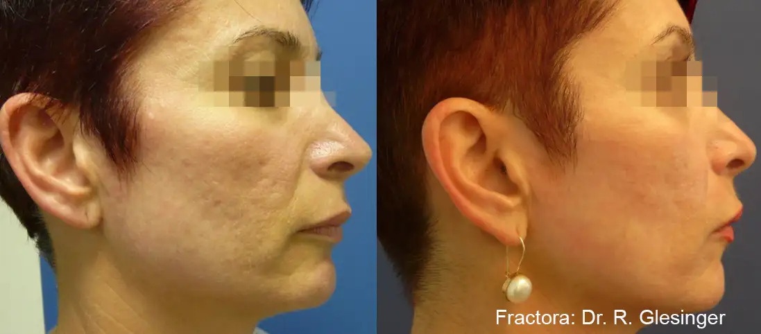Fractora Skin Resurfacing - Astelas Aesthetics
